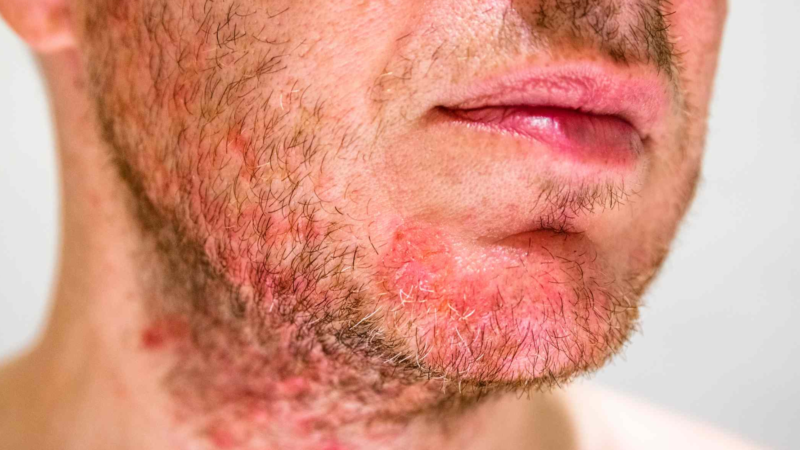 Folliculitis: causes and treatments | Medicosmetica